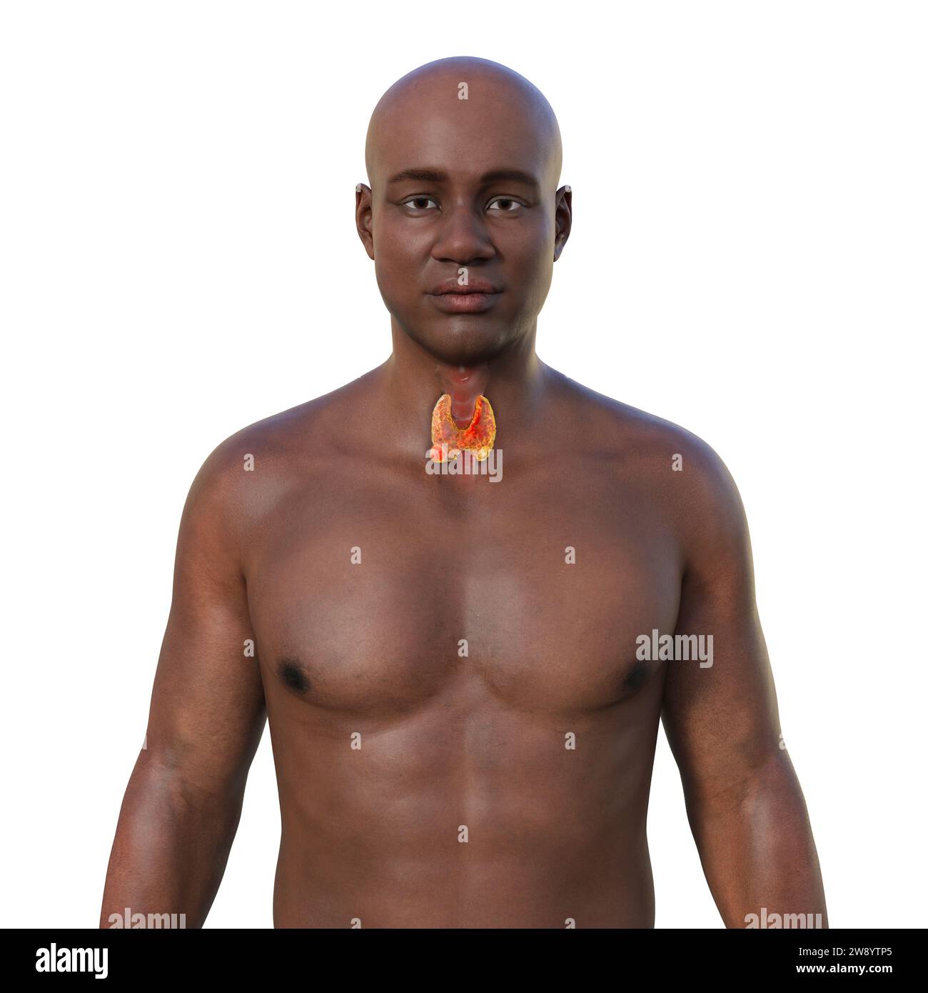 Cancer de la thyroïde, illustration Photo Stock - Alamy