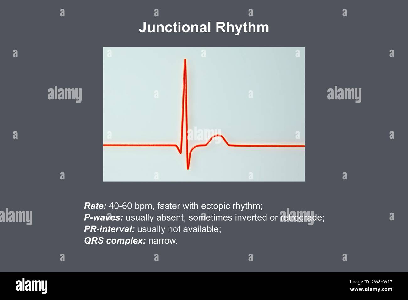 Illustration d'un électrocardiogramme (ECG) affichant un rythme ...