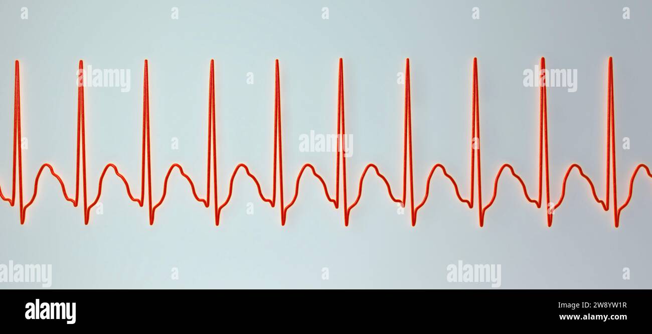Illustration d'un électrocardiogramme (ECG) montrant une tachycardie ...