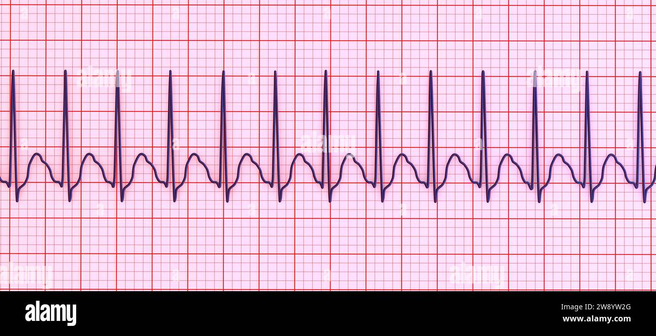 Tachycardie supraventriculaire rythme cardiaque, illustration Photo ...