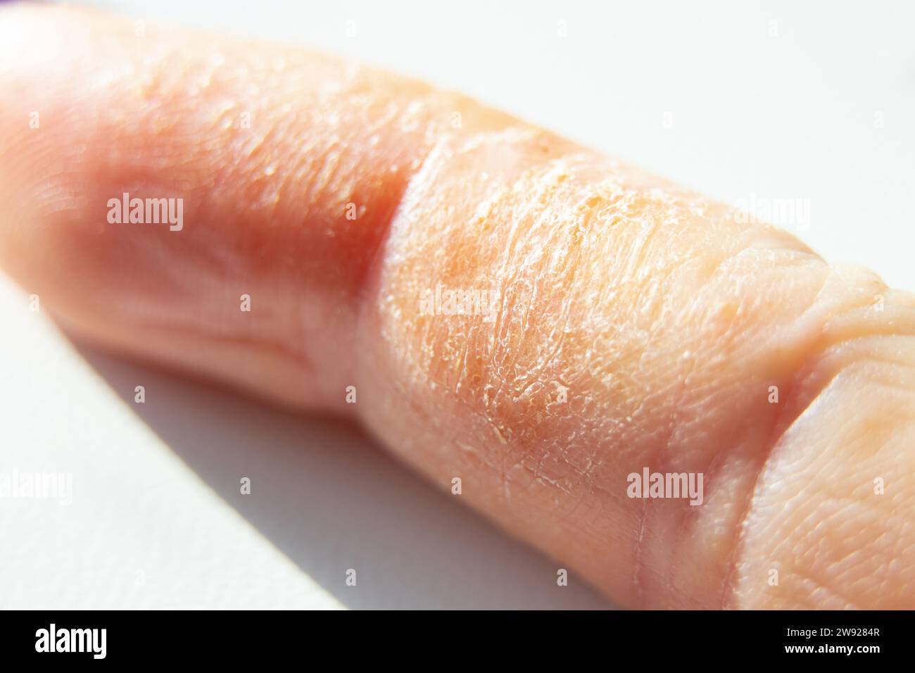 Réaction allergique et éruption cutanée sur le doigt, irritation ...