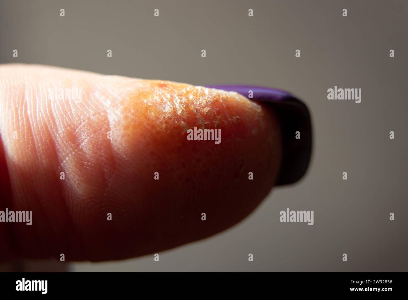 Réaction allergique et éruption cutanée sur le doigt, irritation ...