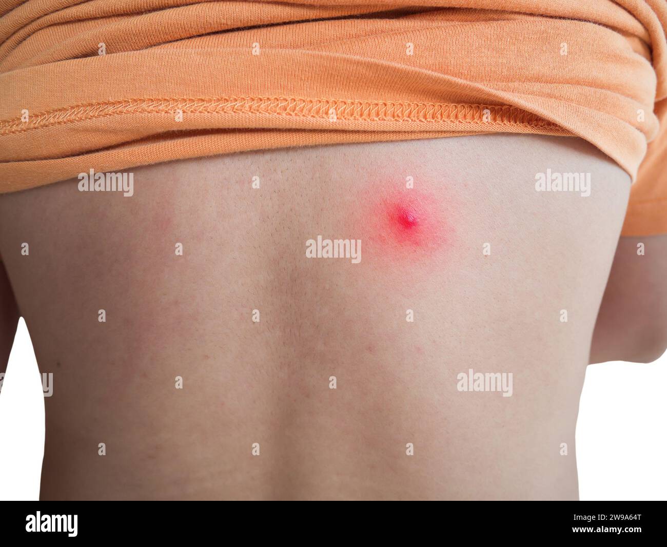 Tache rouge peau sur cicatrice Banque de photographies et d’images à ...