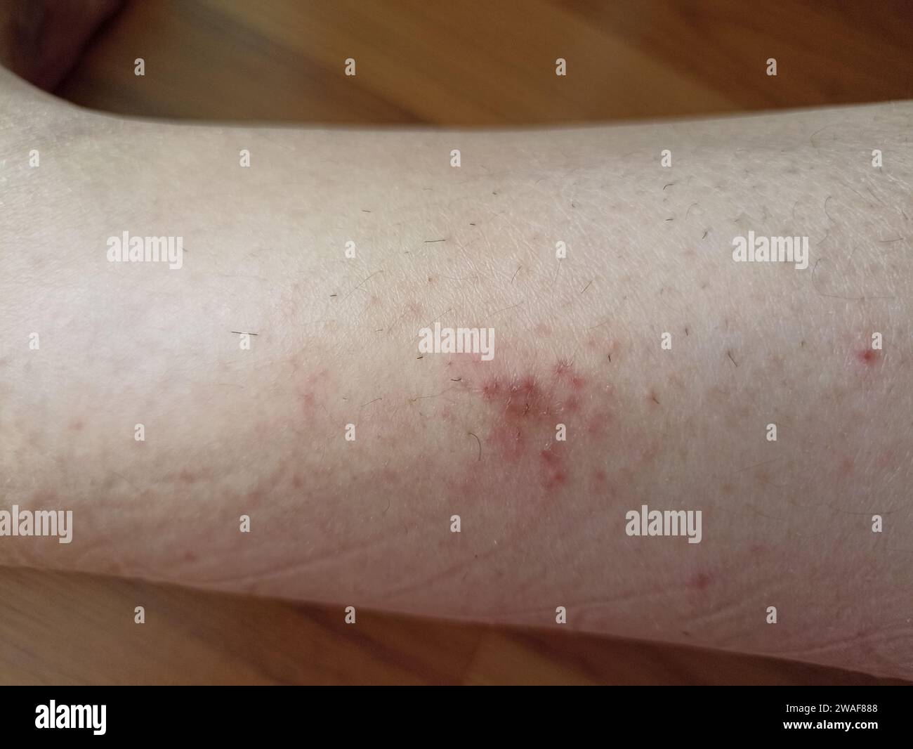 Peau de psoriasis jambe Banque de photographies et d’images à haute ...