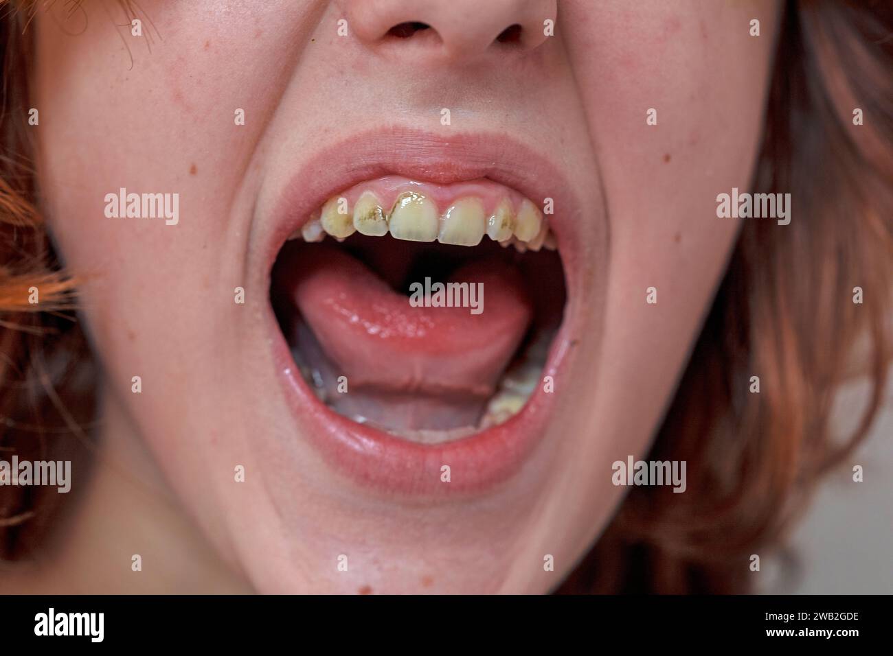 Fille ouvre la bouche Banque de photographies et d’images à haute résolution - Alamy
