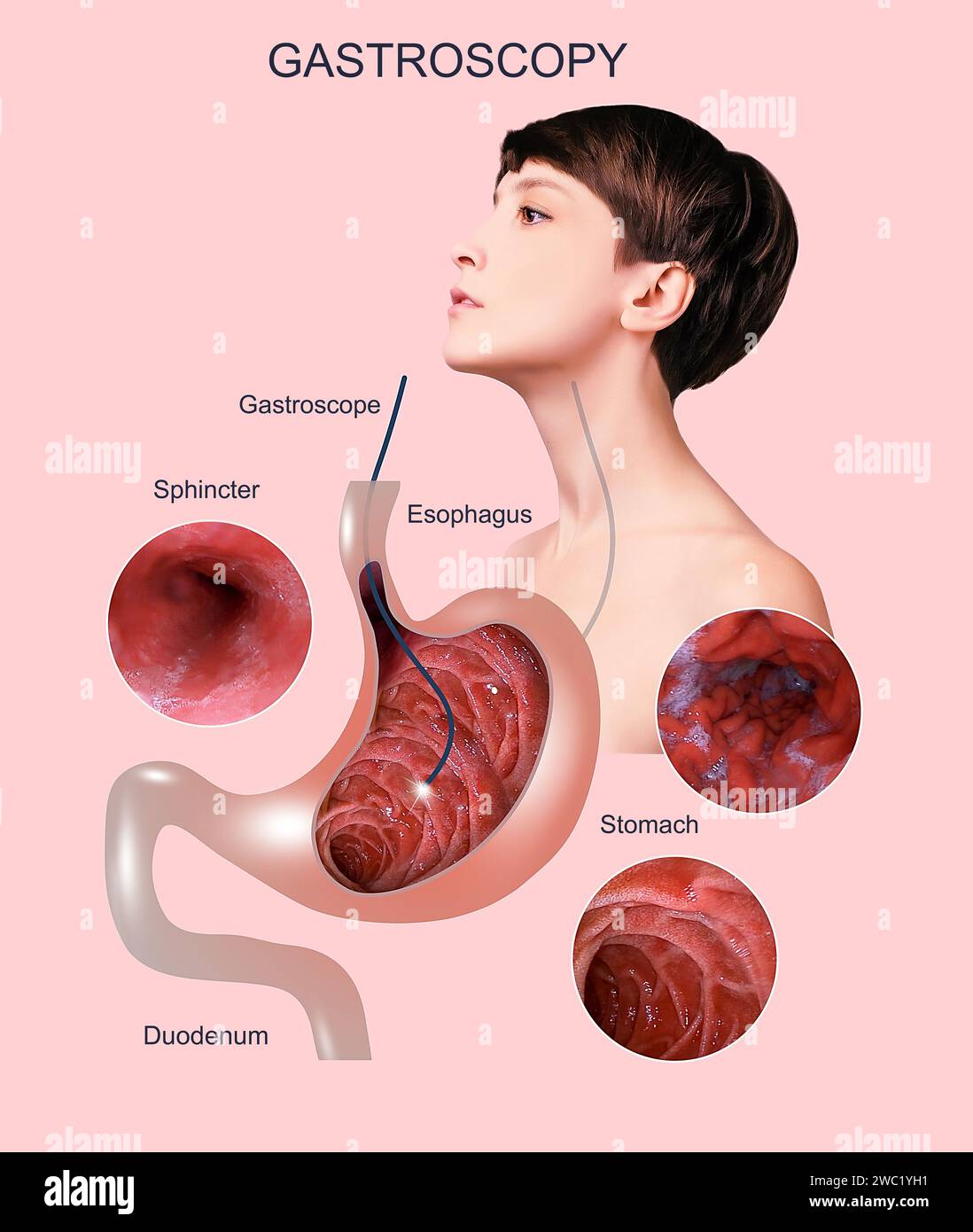 Endoscopie digestive ou gastroscopie. Exécution d'une procédure de gastroscopie. Diagnostic des ...