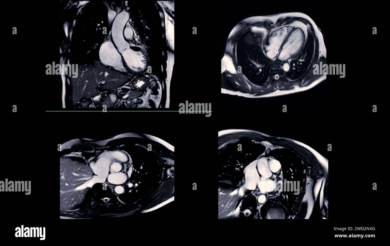 Les images IRM cardiaques sont essentielles pour évaluer la santé ...