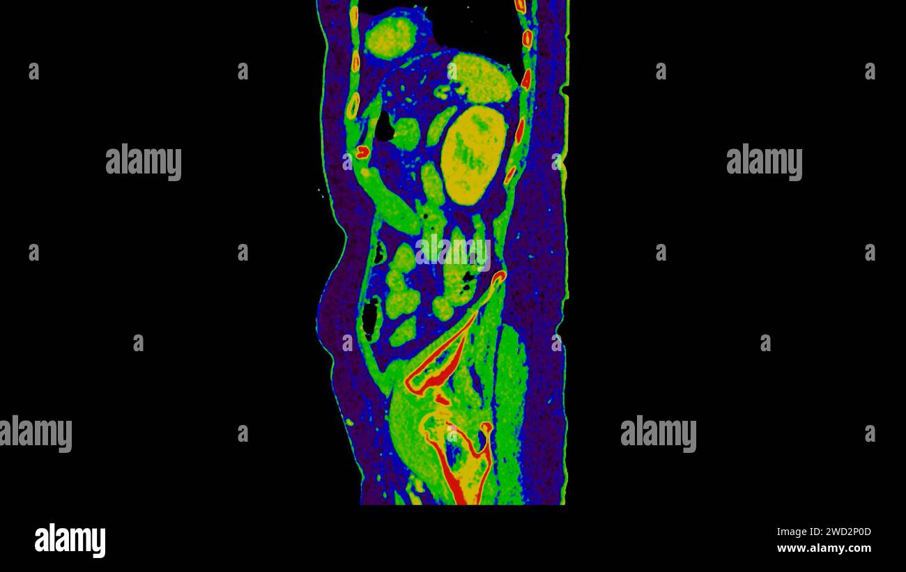 Abdominal ct scan abdomen Banque de photographies et d’images à haute ...