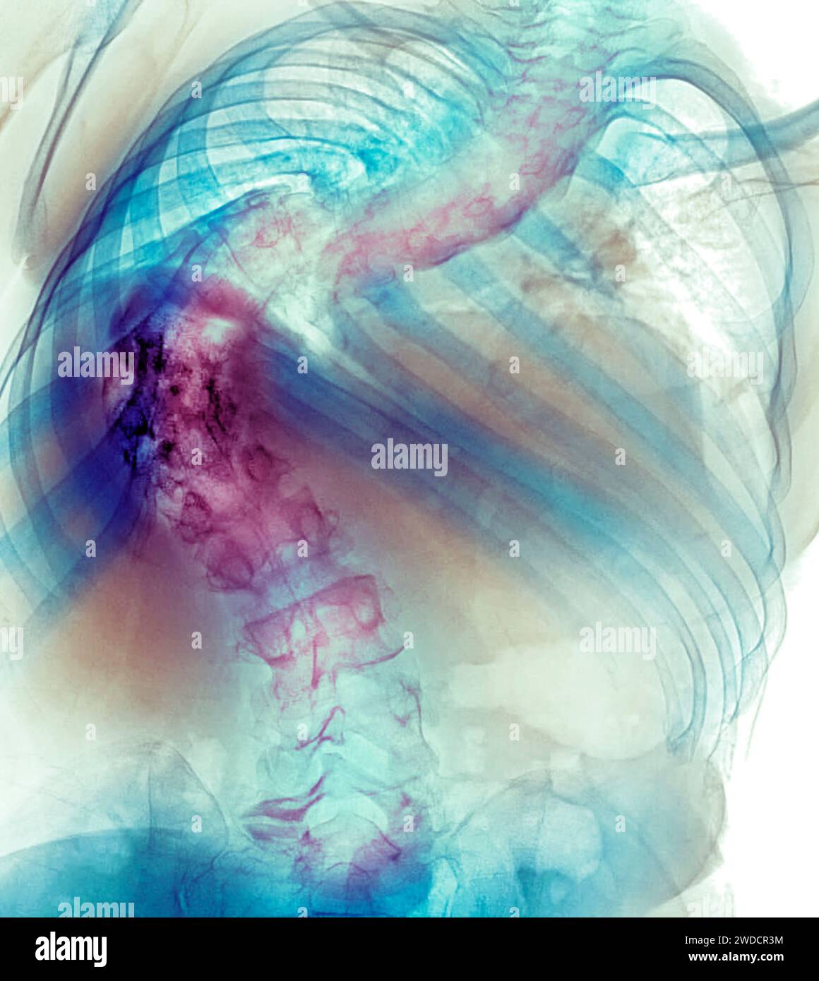 Scoliose aux rayons x Banque de photographies et d’images à haute ...