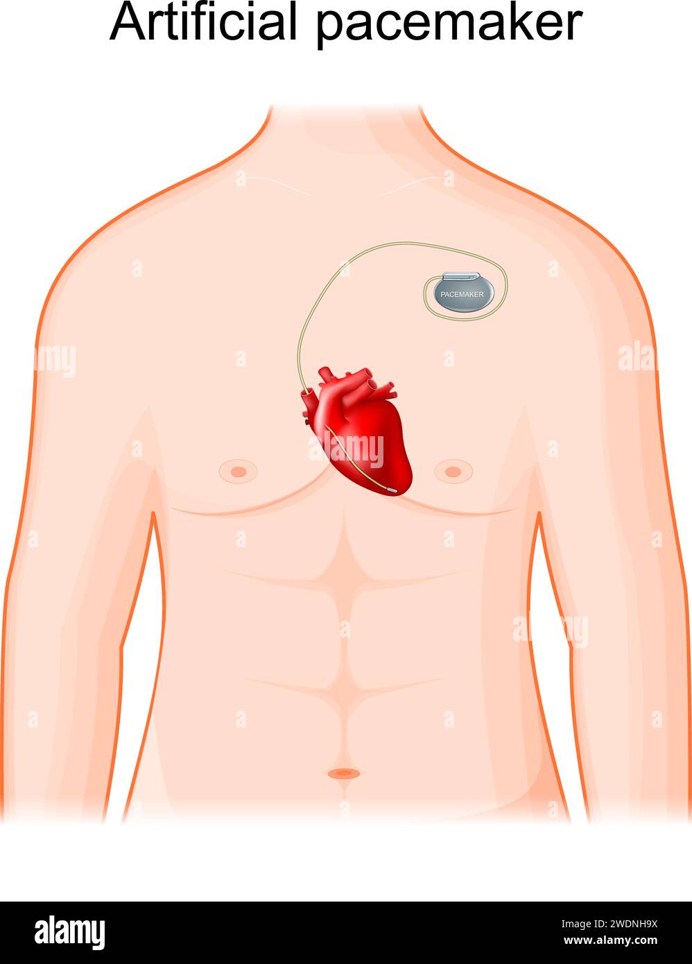 Artificial cardiac pacemaker Banque d'images vectorielles - Alamy