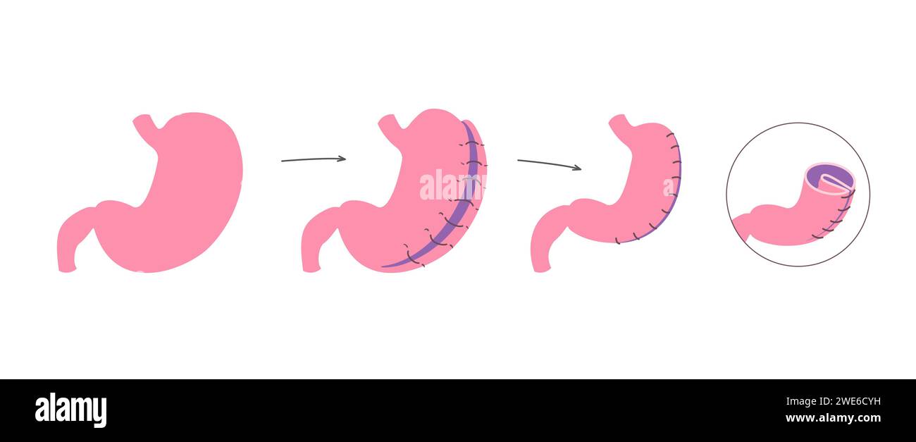 Infographie plate de plicature gastrique. L'image explicative de l ...