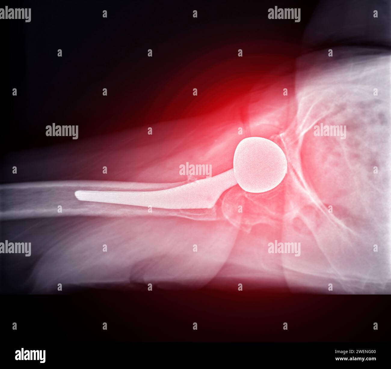 Une radiographie révèle les deux articulations de la hanche avec ...