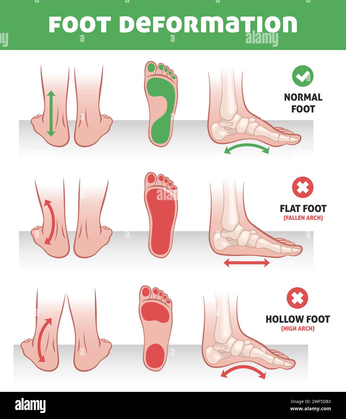 Déformation du pied. Infographies de pathologie des pieds, position ...