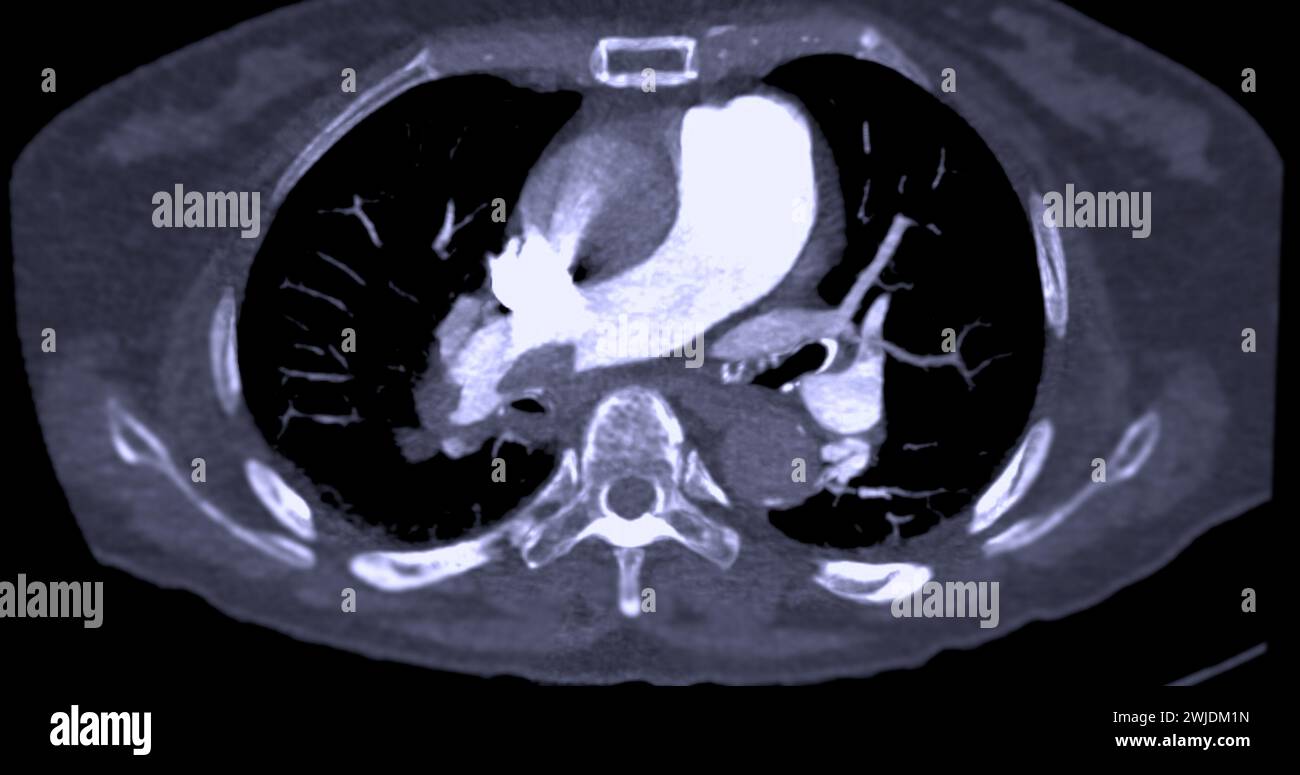 Une artère pulmonaire TDM révèle une vue détaillée des vaisseaux ...