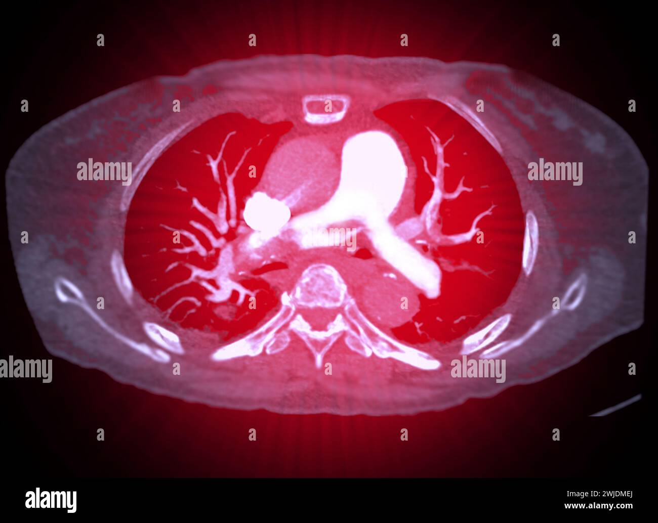 Une artère pulmonaire TDM révèle une vue détaillée des vaisseaux ...