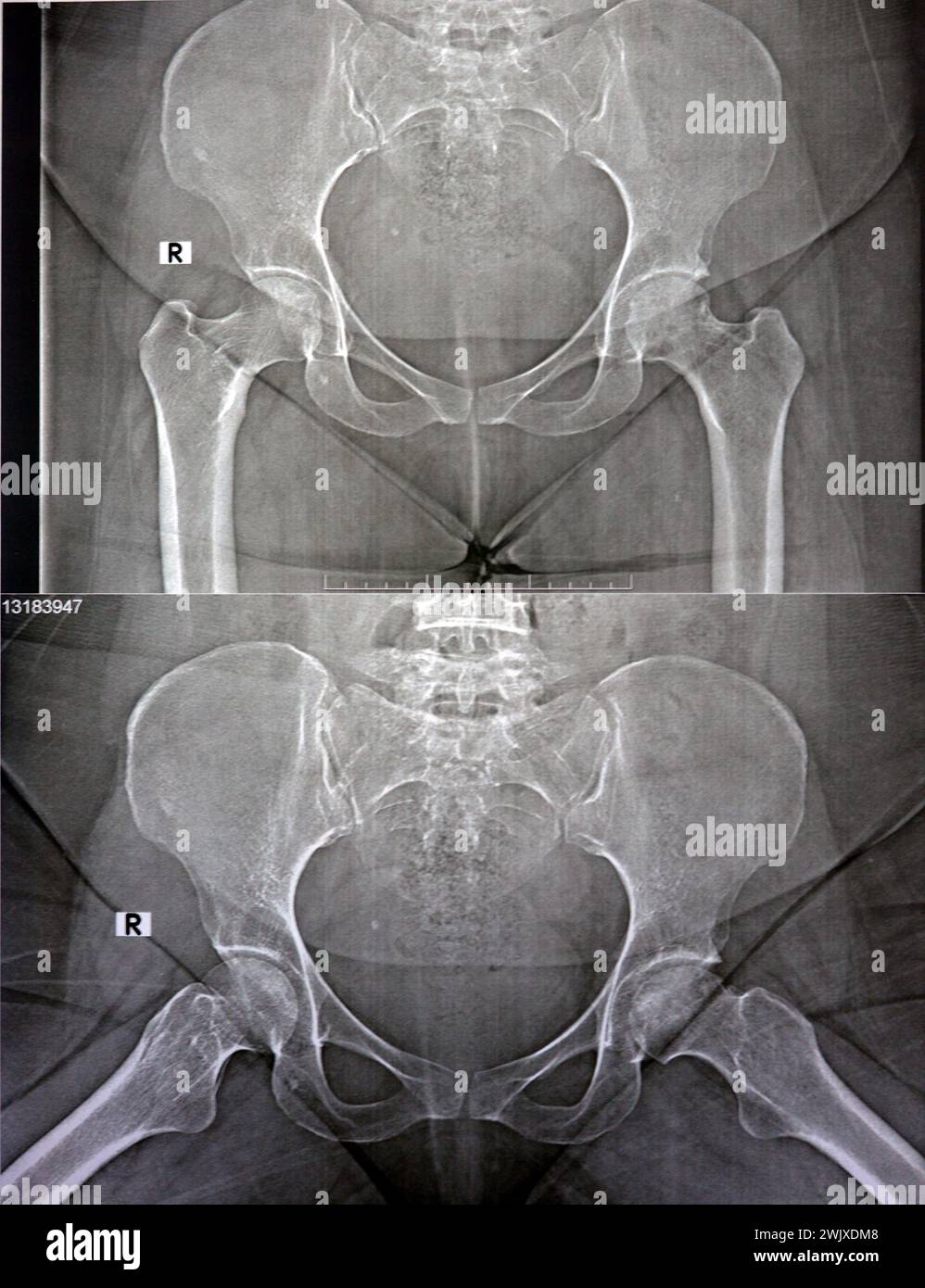 La radiographie simple révèle une nécrose avasculaire bilatérale (AVN ...