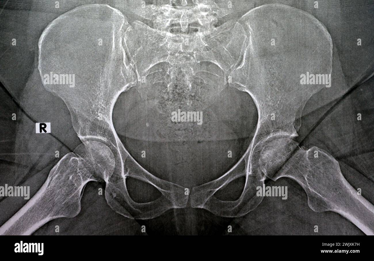 La radiographie simple révèle une nécrose avasculaire bilatérale (AVN ...