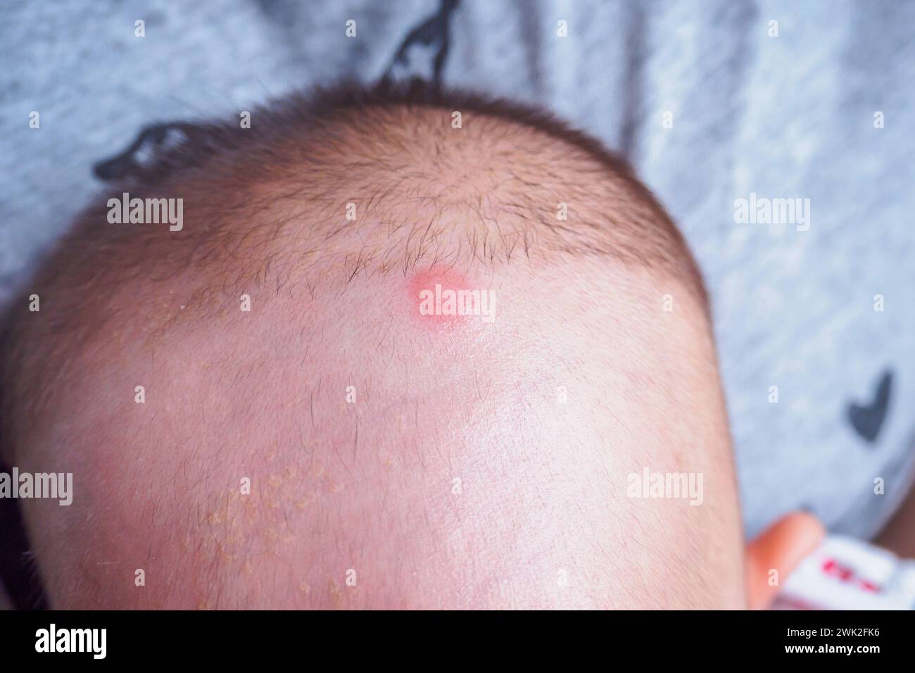 Petite tache rouge peau Banque de photographies et d’images à haute ...