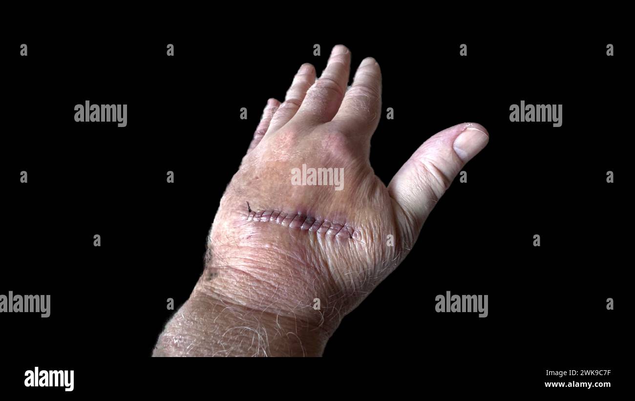 Chirurgie mohs Banque de photographies et d’images à haute résolution ...