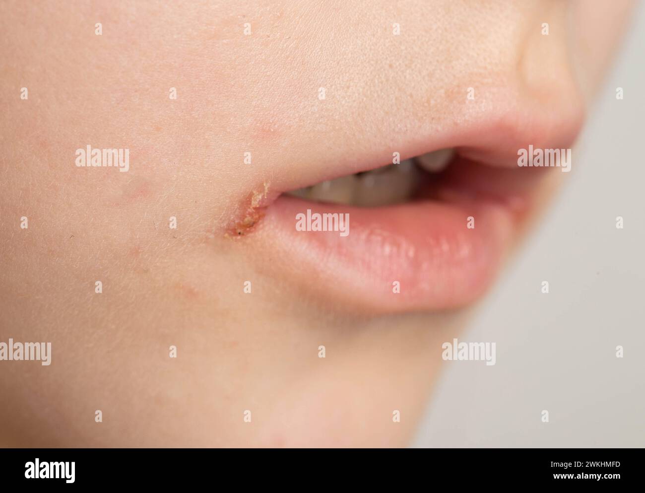 Maladie dermatologique Banque de photographies et d’images à haute ...
