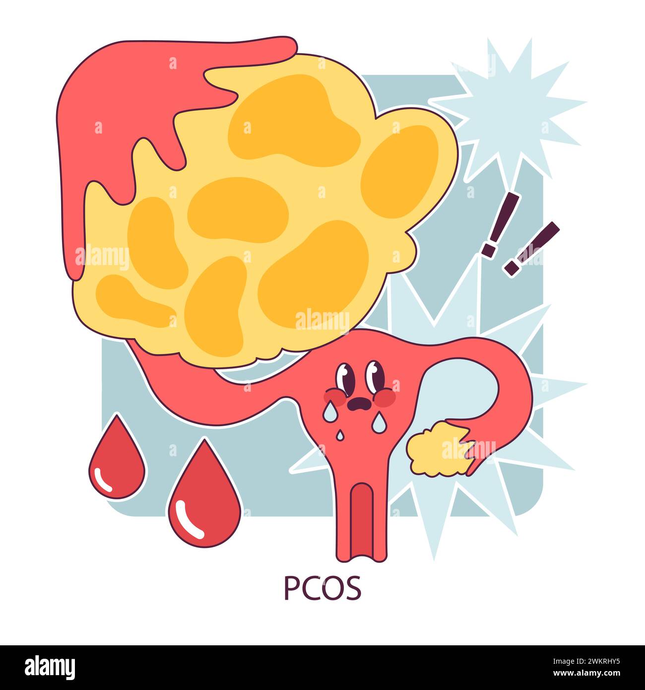 SOPK, syndrome des ovaires polykystiques. Appareil reproducteur féminin ...