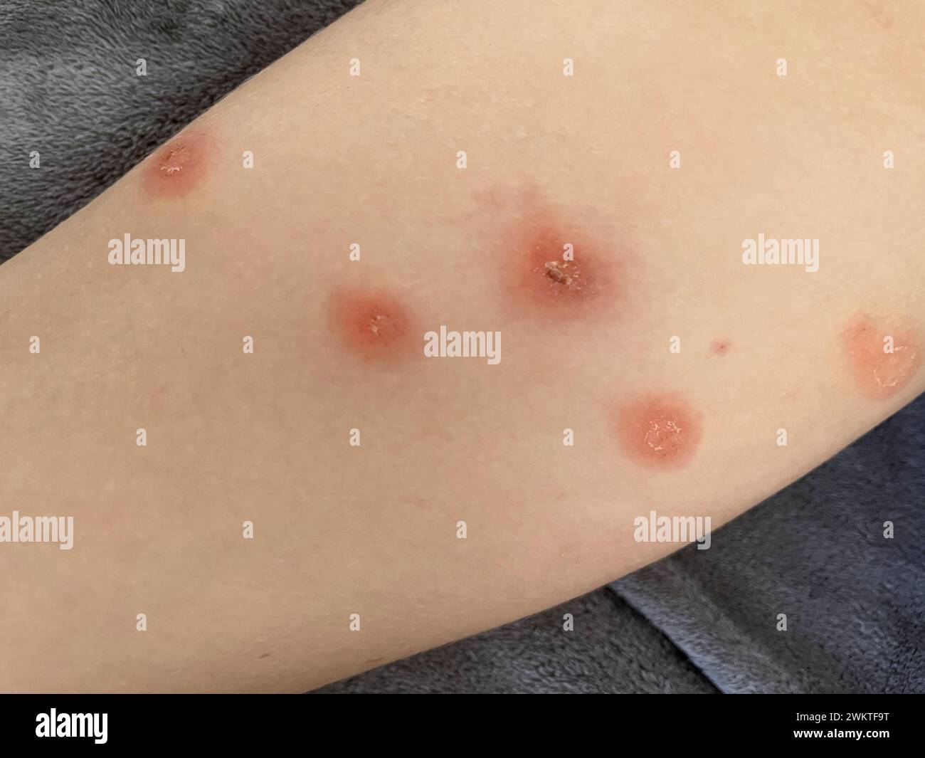 Gros plan sur la jambe humaine. Corps avec problème de peau. Maladie ...