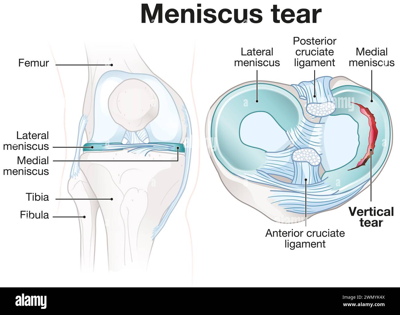 Meniscus tear Banque de photographies et d’images à haute résolution ...