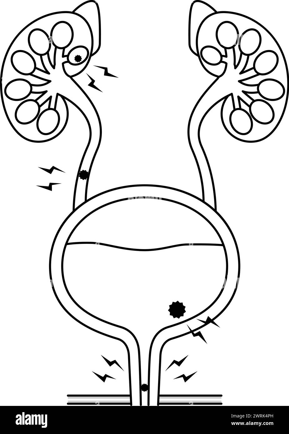 Illustration médicale de calculs urinaires, calculs rénaux, calculs ...