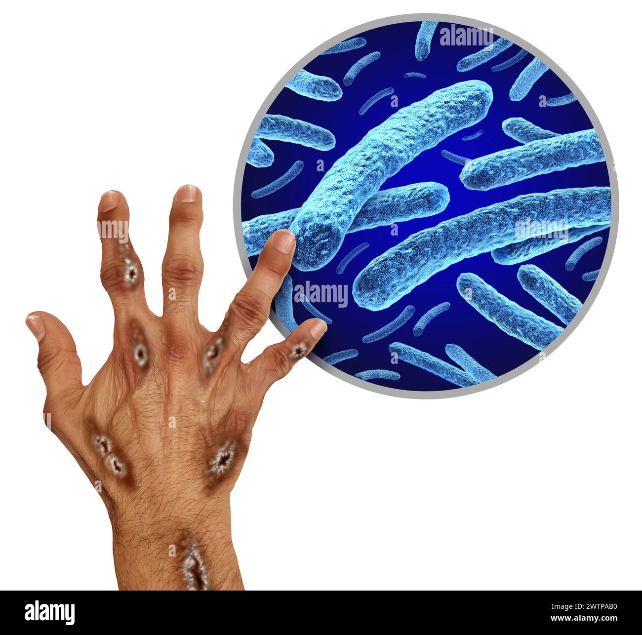 Lèpre et Mycobacterium leprae bactéries comme symptômes d'une maladie ...