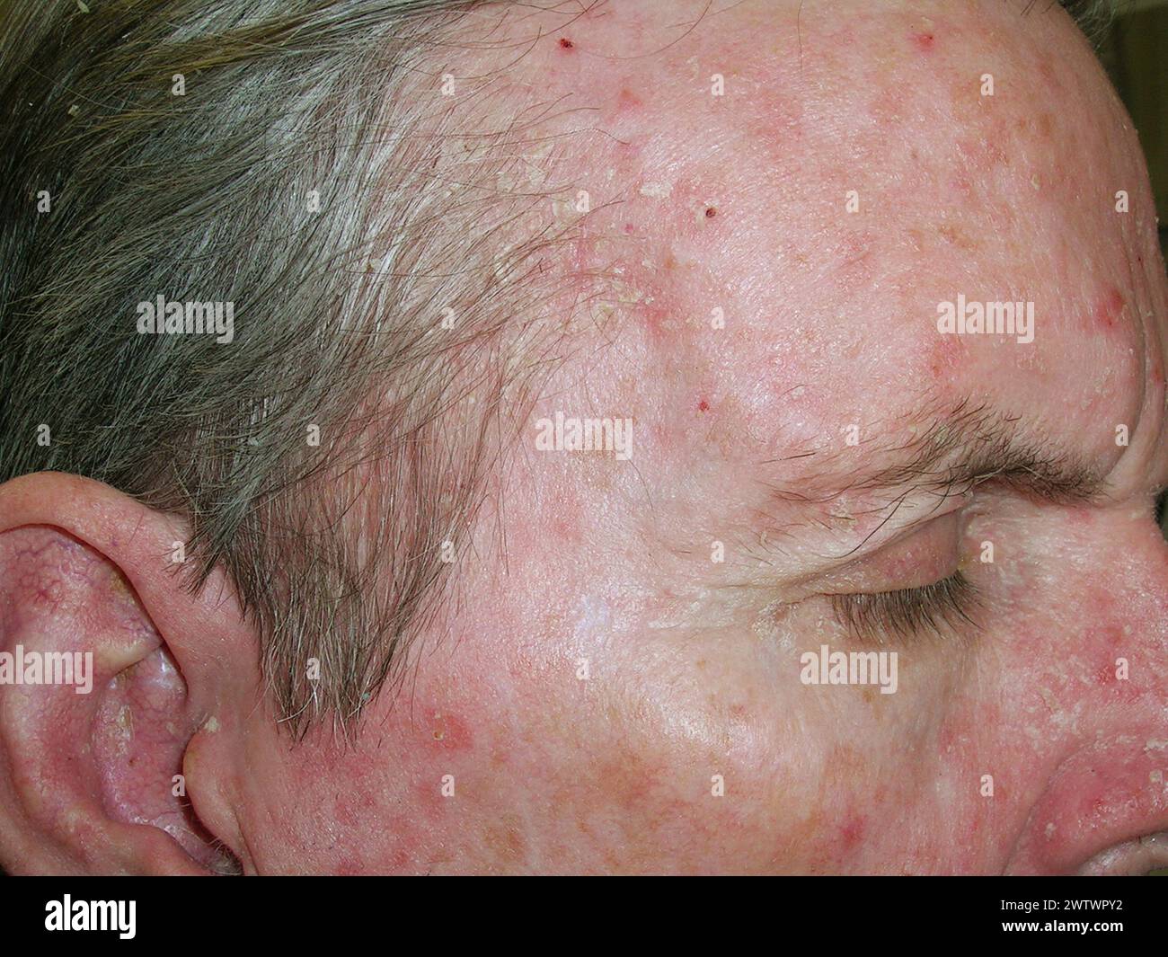 Usage éditorial seulement dermatite séborrhéique et lésion solaire sur ...