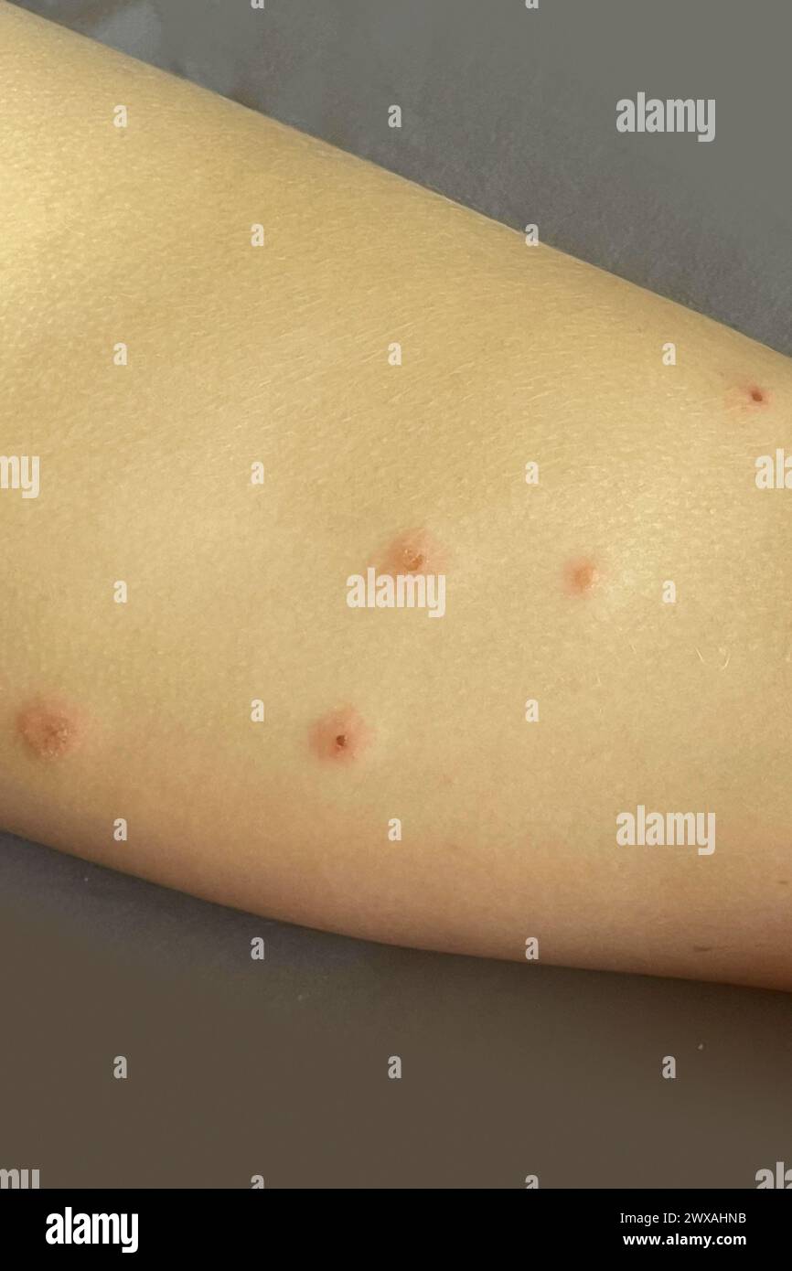 Peau de psoriasis jambe Banque de photographies et d’images à haute ...