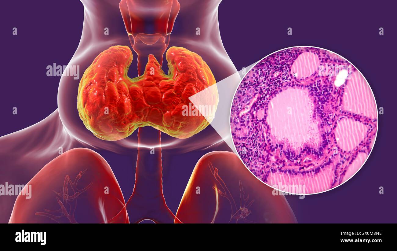 Colloïde thyroïdien Banque de photographies et d’images à haute ...