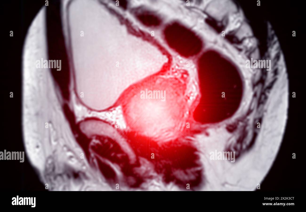 Prostate et vessie Banque de photographies et d’images à haute ...