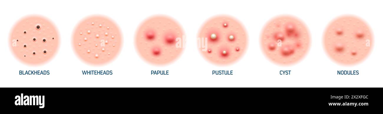 Kyste sébacé Banque de photographies et d’images à haute résolution - Alamy