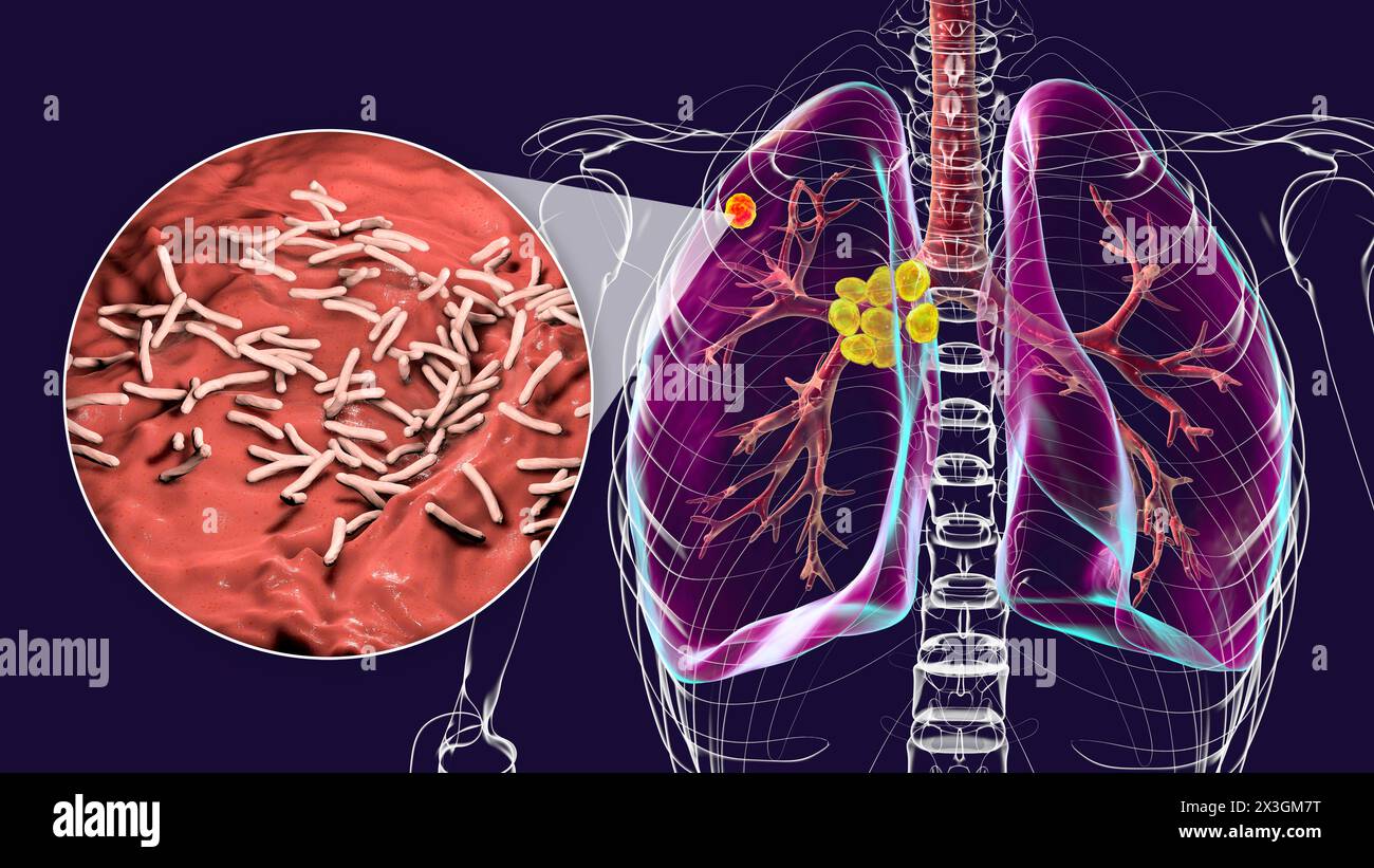 Tuberculose pulmonaire primaire Banque de photographies et d’images à ...