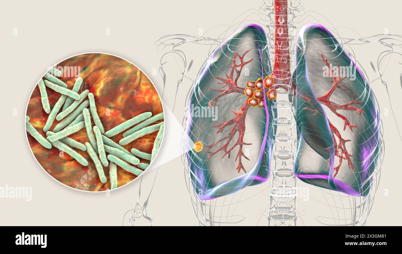 Tuberculose pulmonaire primaire Banque de photographies et d’images à ...