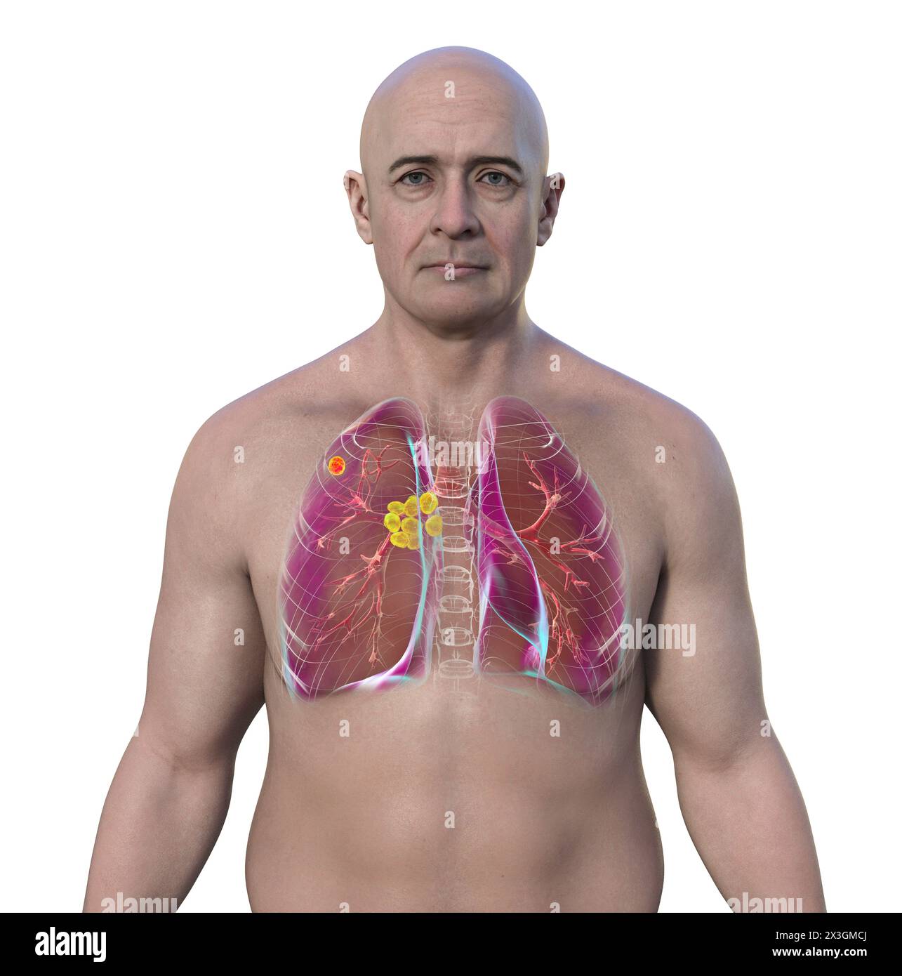 Tuberculose pulmonaire primaire Banque de photographies et d’images à ...