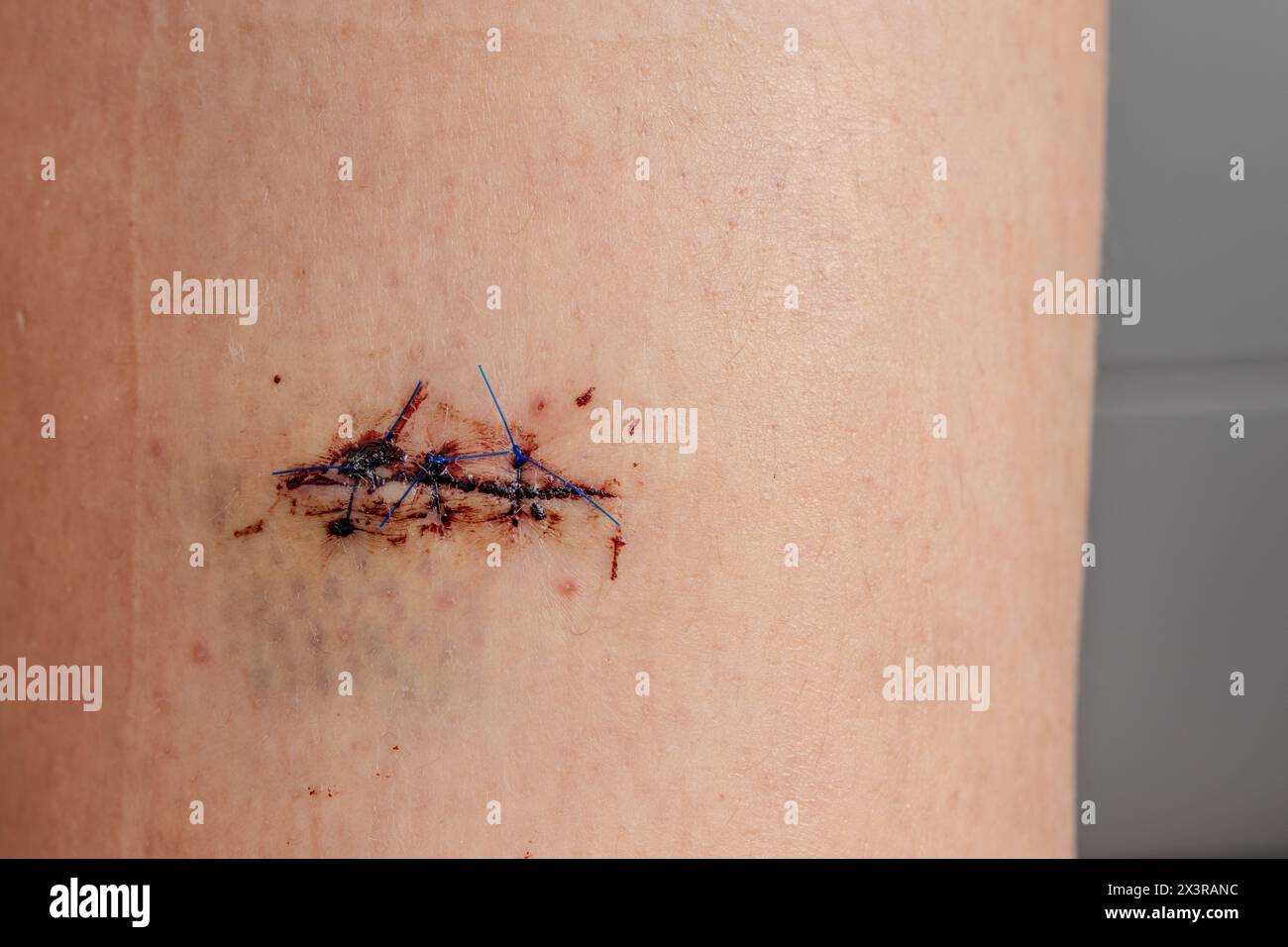 Sutures médicales, sutures après chirurgie, sutures chirurgicales ...