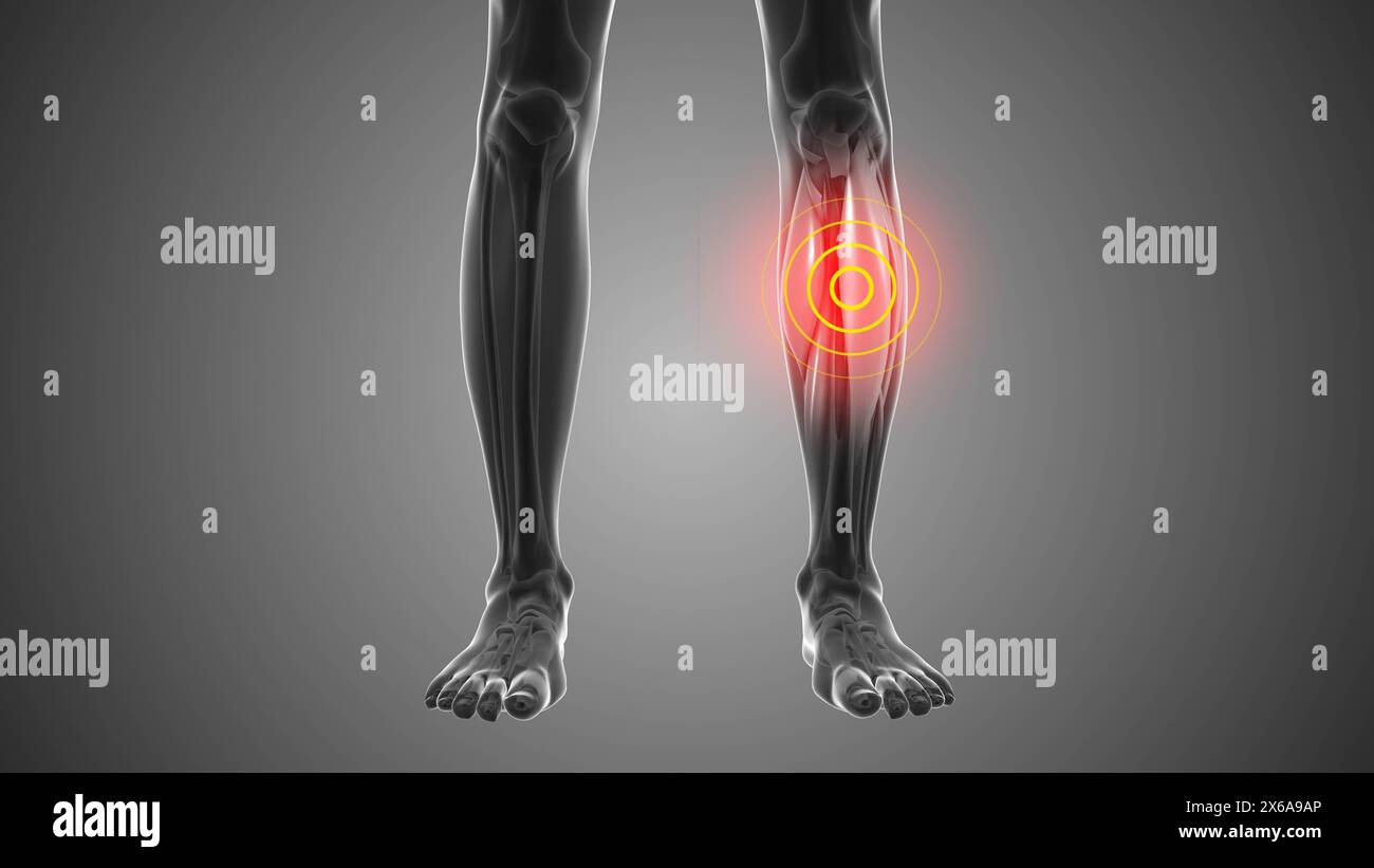 Douleur au tibia Banque de photographies et d’images à haute résolution ...