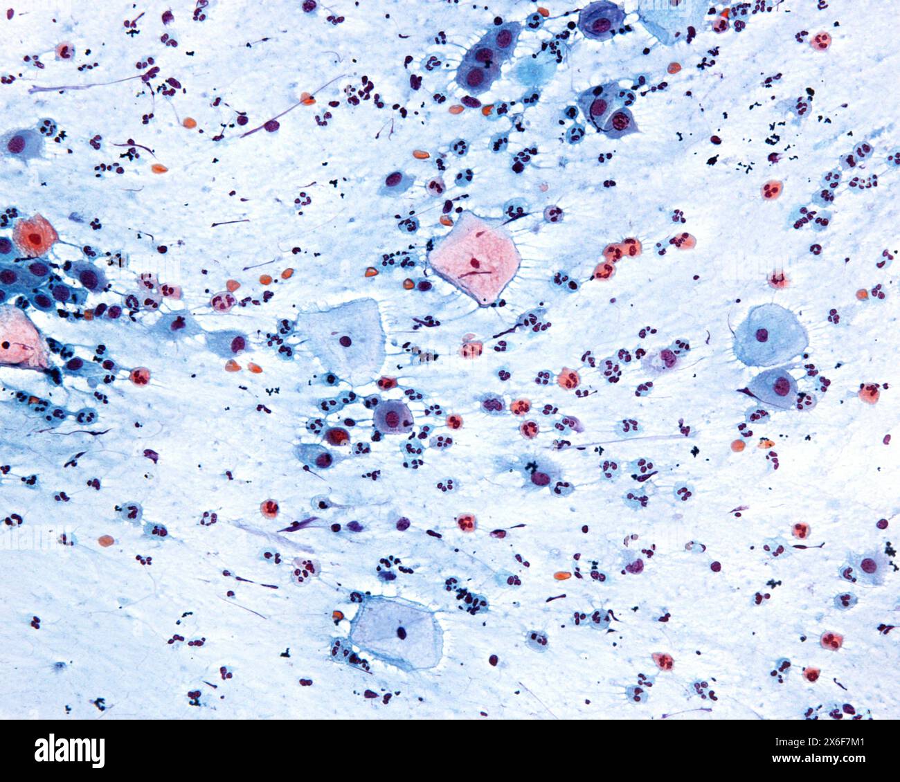 Micrographie à la lumière d'un frottis vaginal coloré par la méthode de ...
