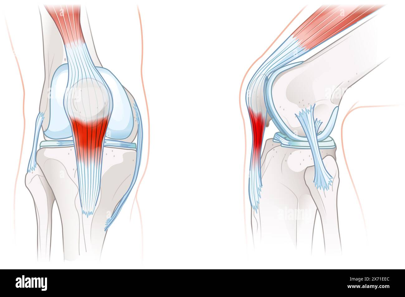Tendinite du quadriceps Banque d'images détourées - Alamy