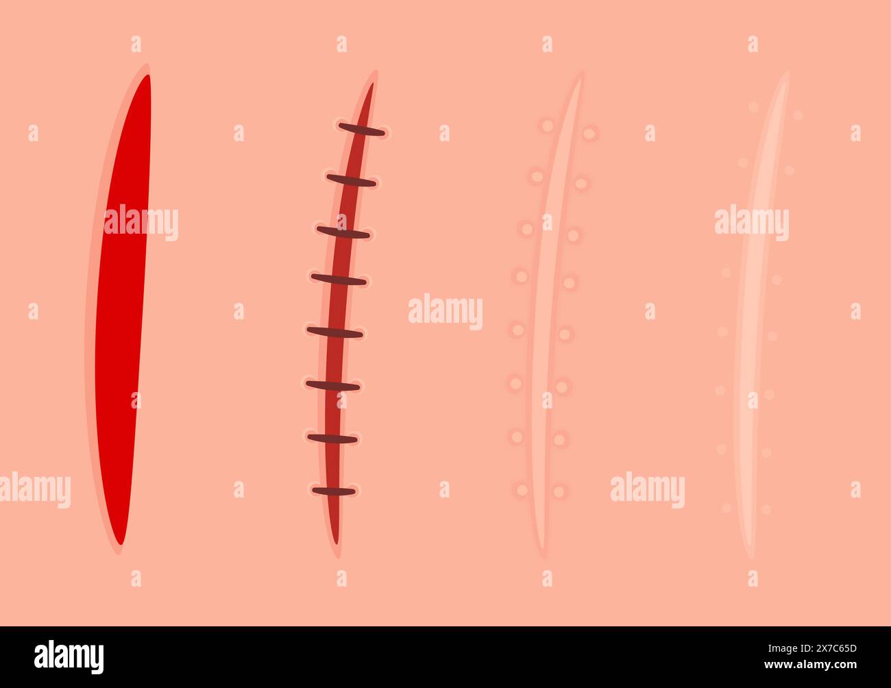 Processus chirurgical Banque d'images vectorielles - Alamy