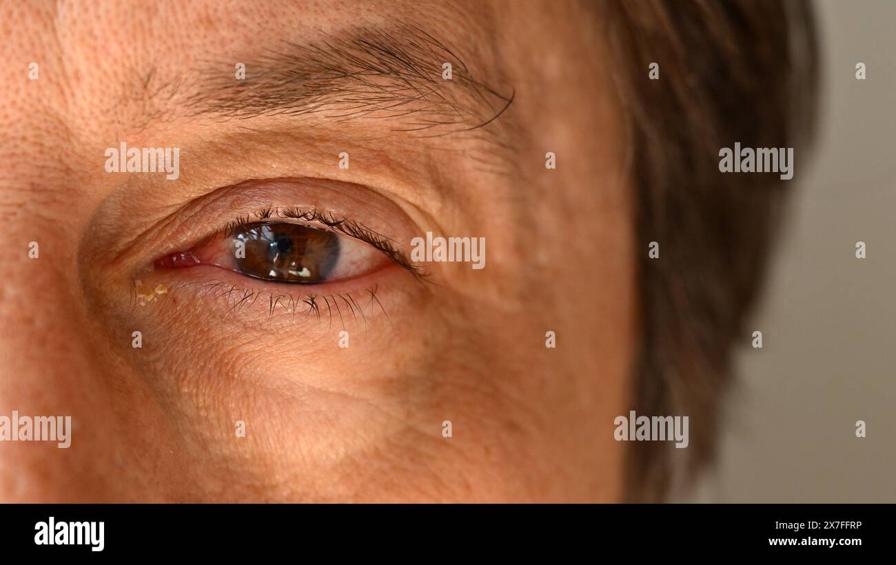 Infection oculaire, gros plan de l'œil masculin avec la maladie de la ...