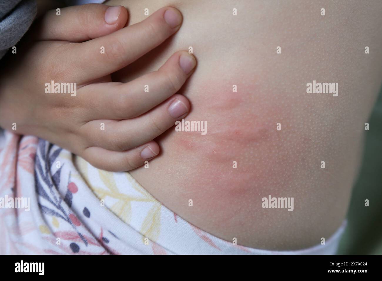 Taches rouges, gonflées et démangeantes sur la peau causées par des ...