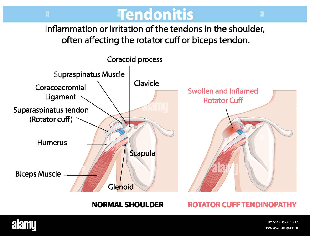 Inflamed tendon Banque d'images vectorielles - Alamy