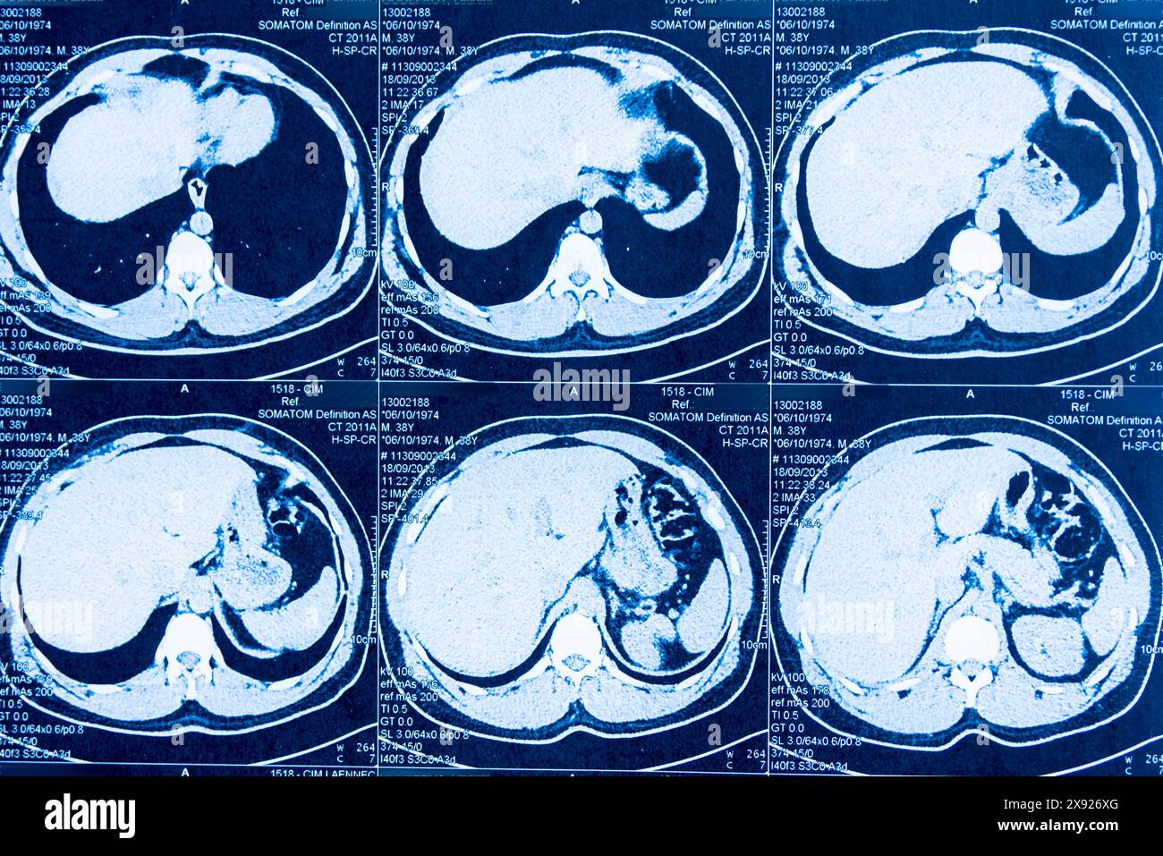 Ct scan abdomen Banque de photographies et d’images à haute résolution ...
