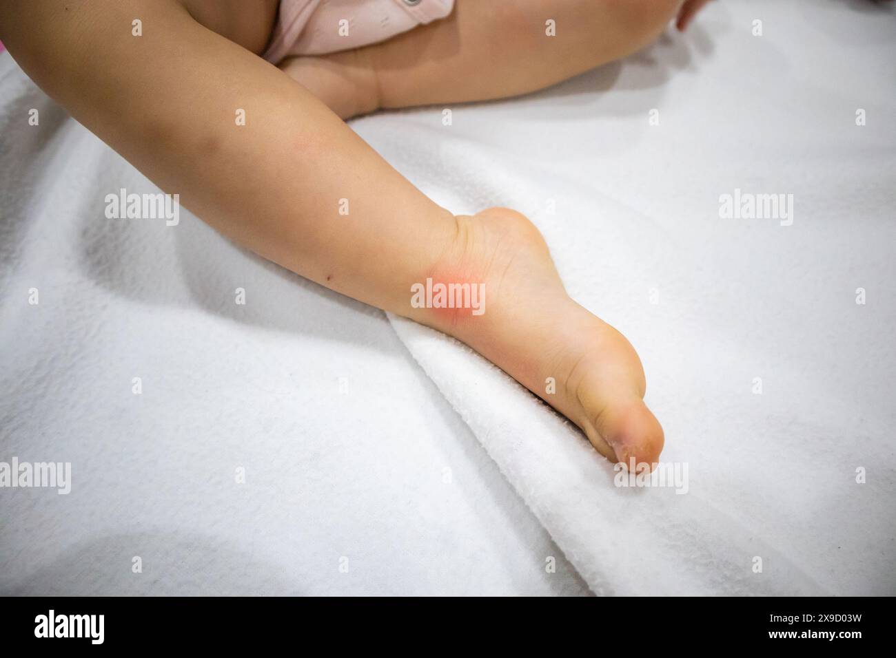 Tache rouge peau sur la jambe Banque de photographies et d’images à ...