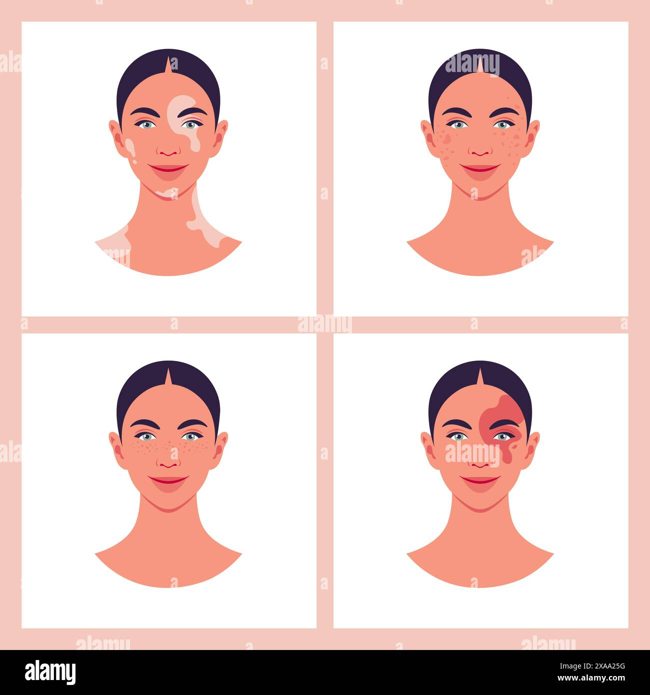 Pigmentation faces Banque de photographies et d’images à haute résolution - Alamy