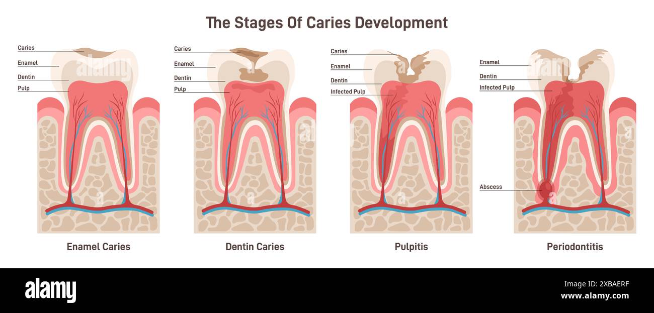 Le développement de la carie. Stades de la maladie dentaire : caries de l'émail et de la dentine ...