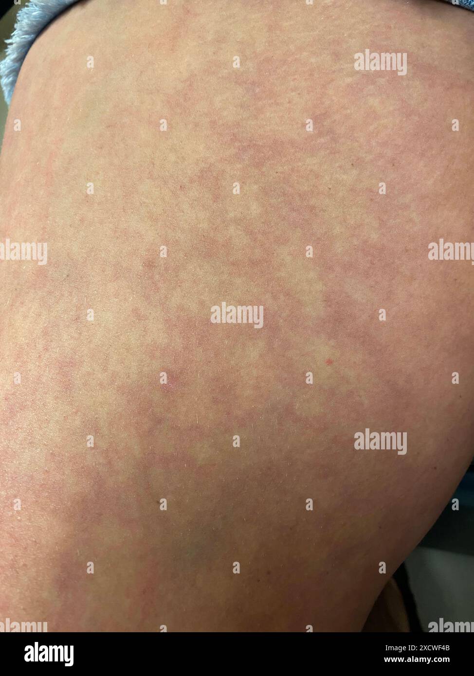 Livedo reticularis sur la cuisse d'une jeune femme. Livedo reticularis ...